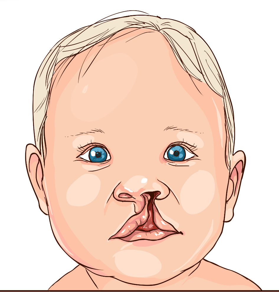 Fixed Cleft Palate